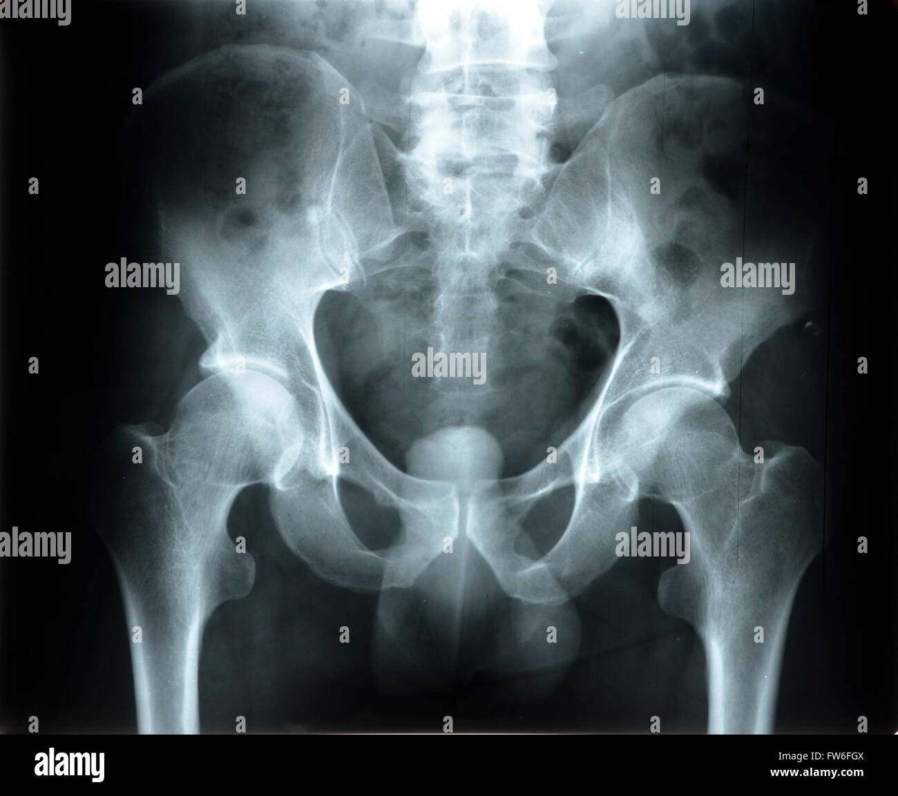 Radiografia spinale immagini e fotografie stock ad alta risoluzione - Alamy