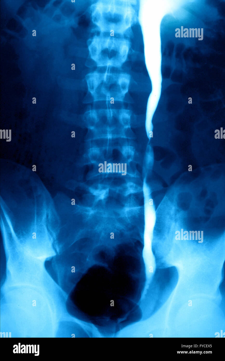 Colica nefritica immagini e fotografie stock ad alta risoluzione - Alamy