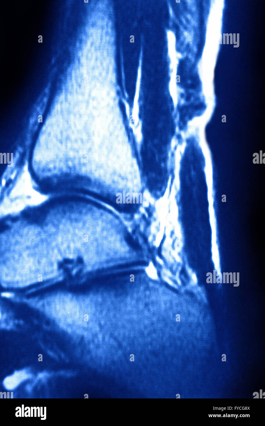 Tacco mri immagini e fotografie stock ad alta risoluzione - Alamy