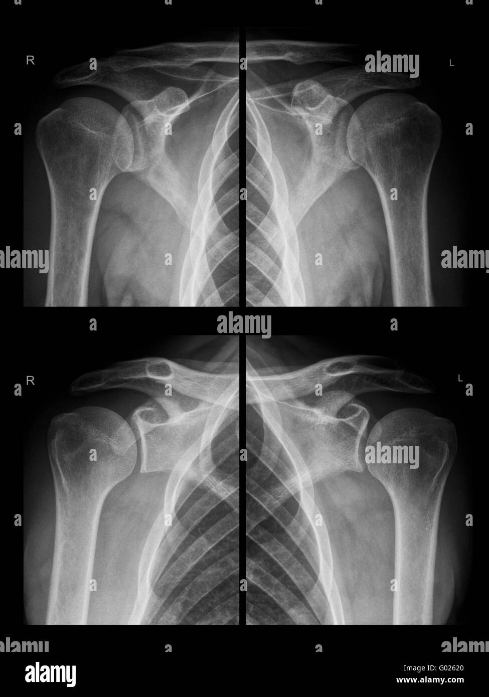 Anatomia umana spalle immagini e fotografie stock ad alta risoluzione ...