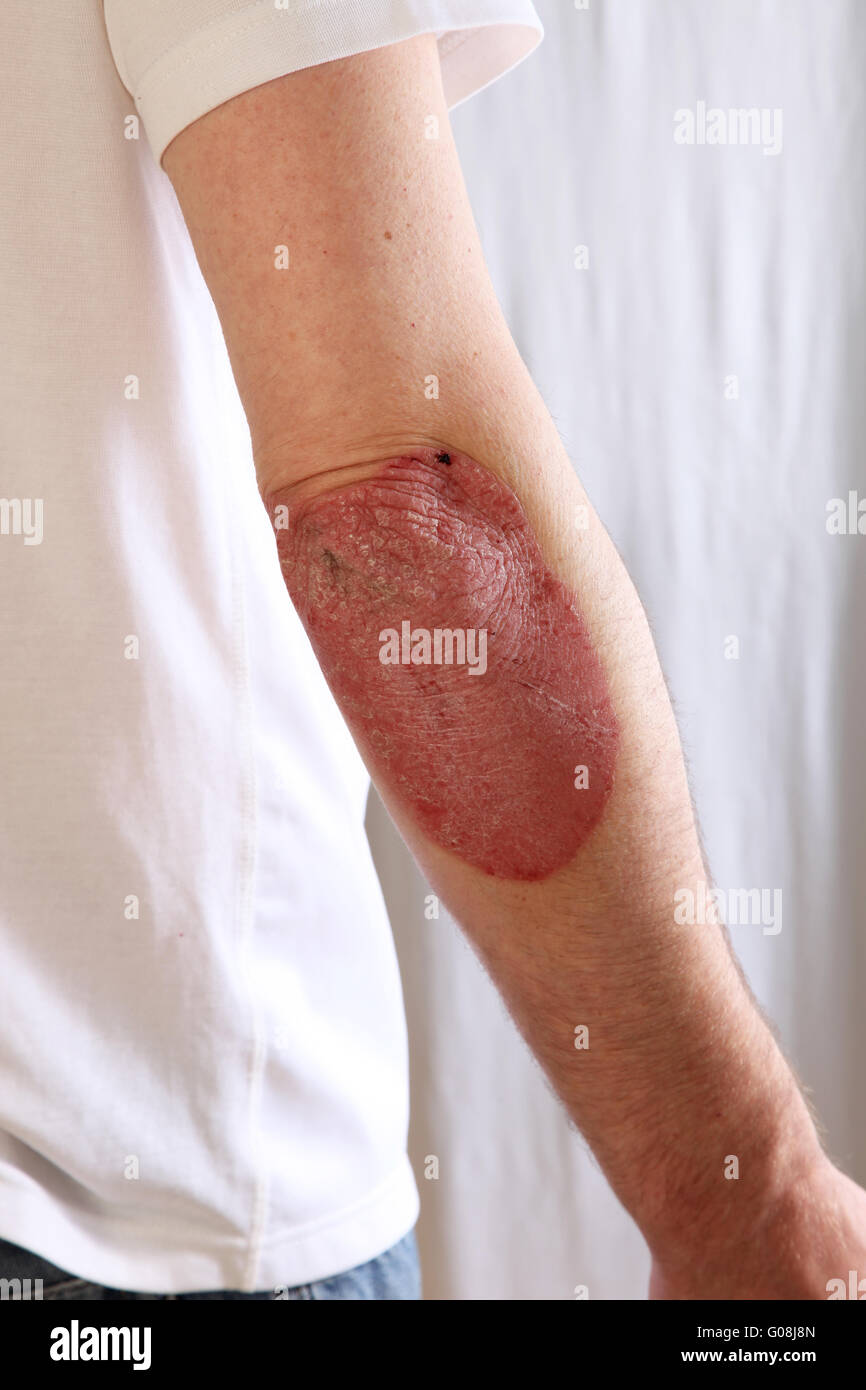 Placche di psoriasi immagini e fotografie stock ad alta risoluzione - Alamy