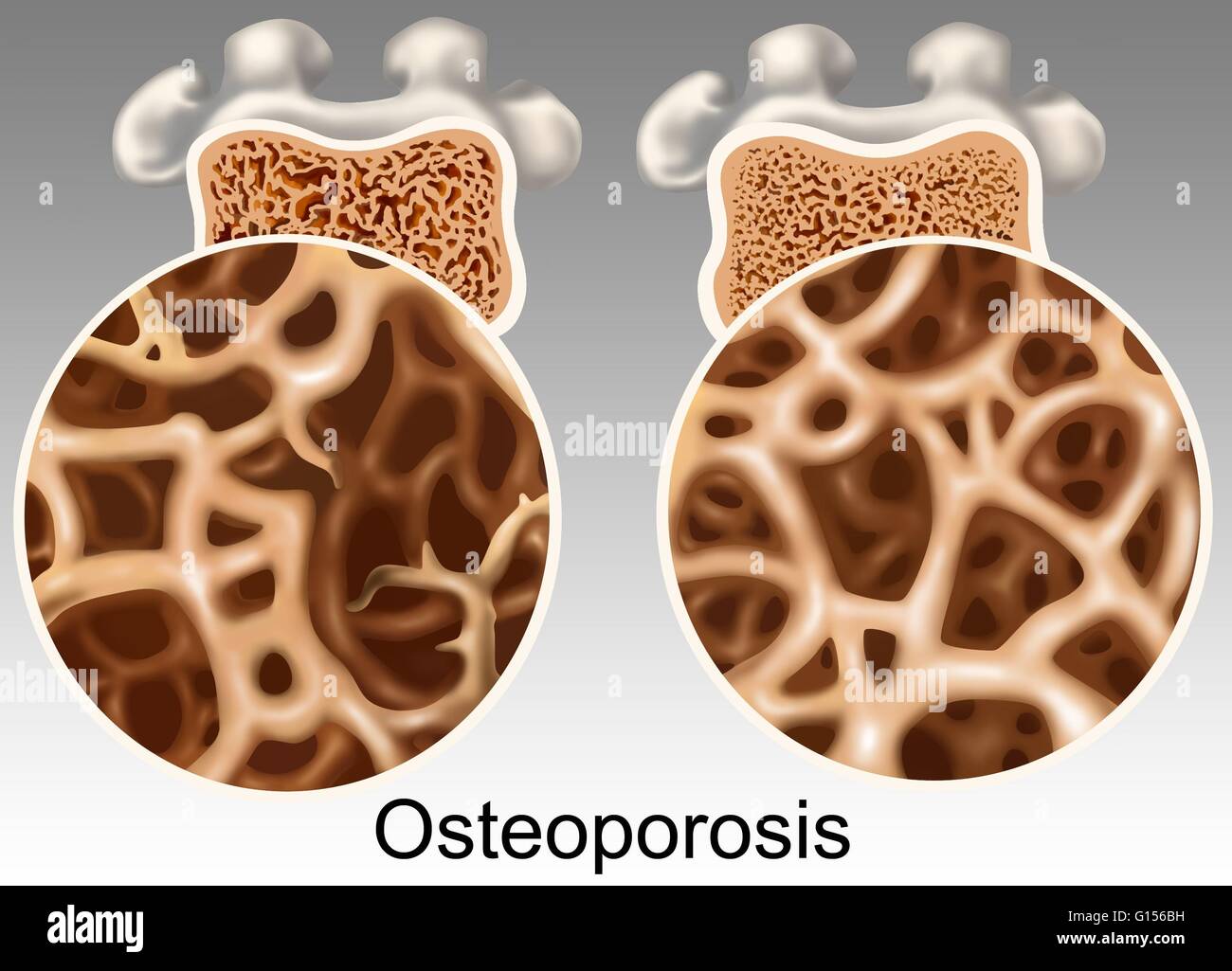 Immagine che mostra il confronto tra un normale e osso affette da ...