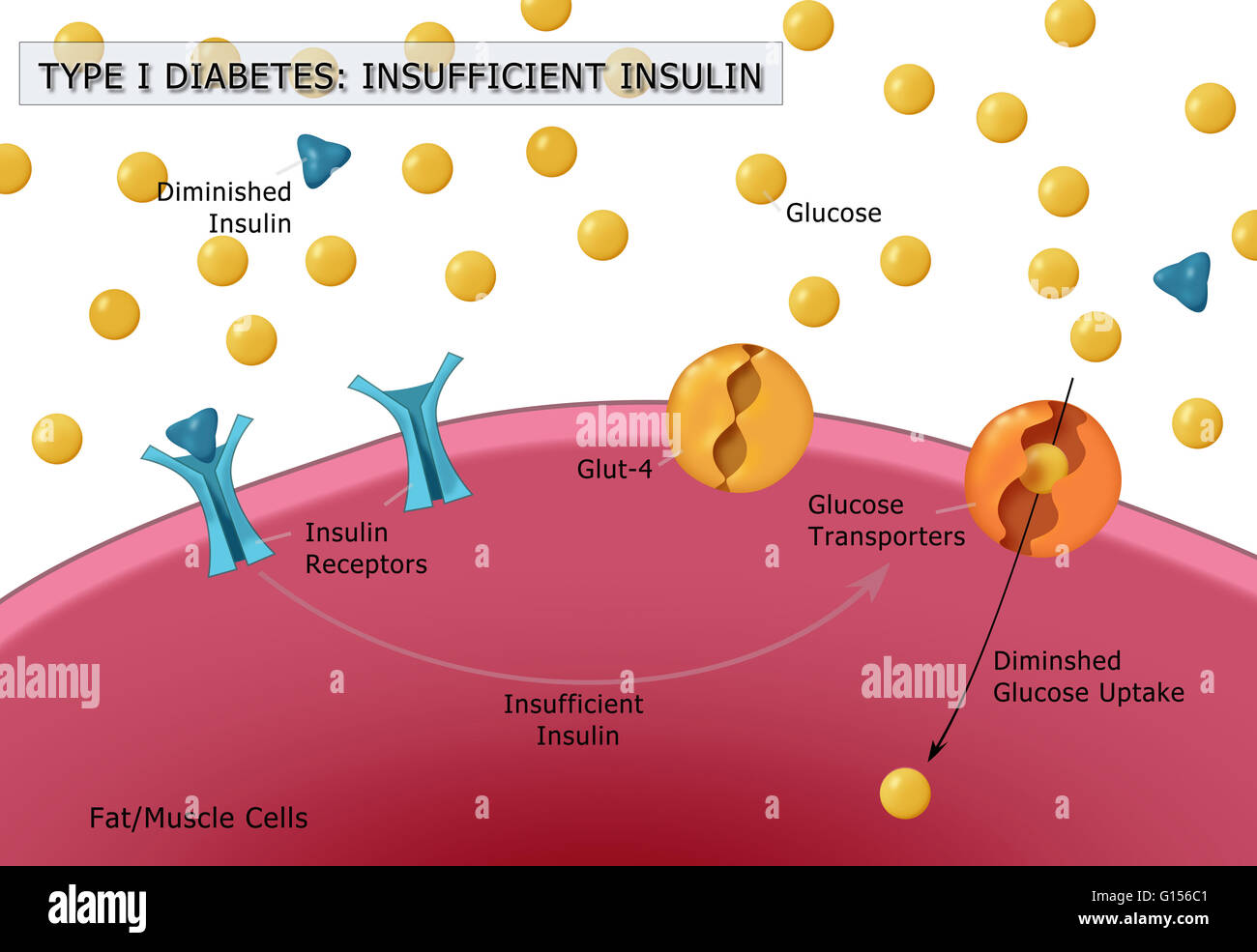 Illustrazione del diabete di Tipo I, definito dalla insufficiente produzione di insulina ...