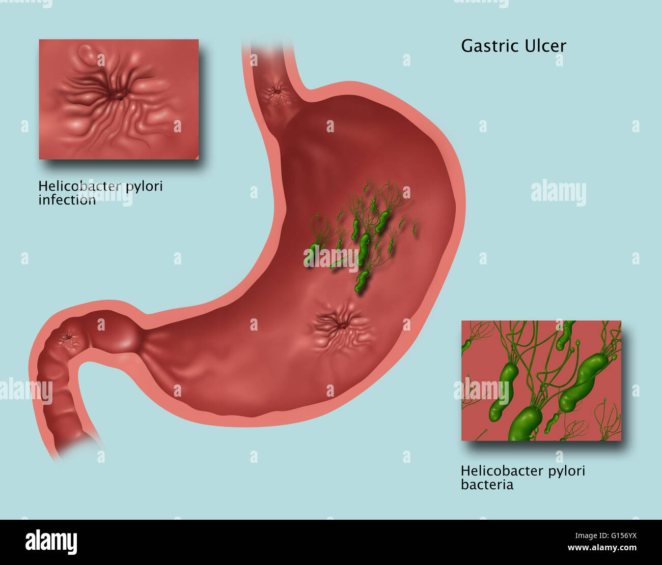Illustrazione Che Mostra Lo Stomaco Con Unulcera Gastrica Causata Da Helicobacter Pylori H