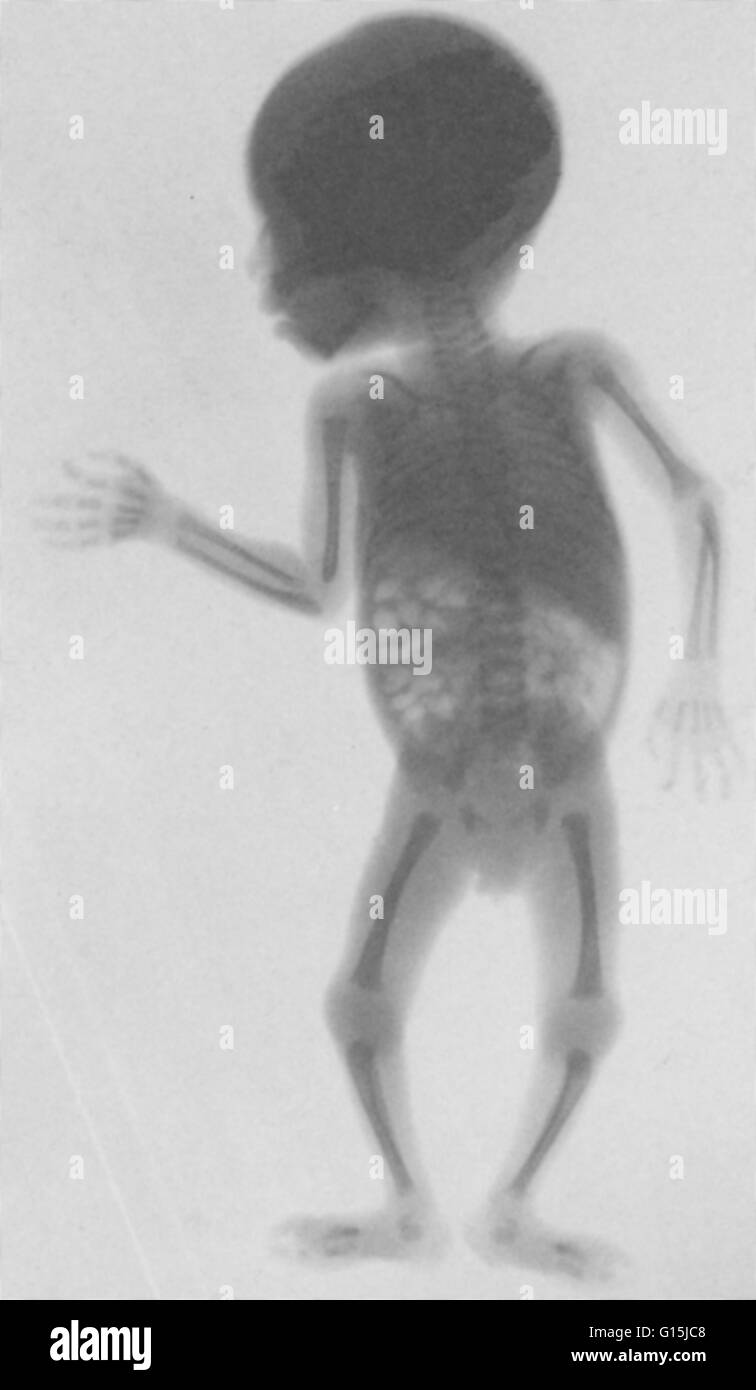 Radiografía del bebé Foto e Immagini Stock in Bianco e Nero - Alamy
