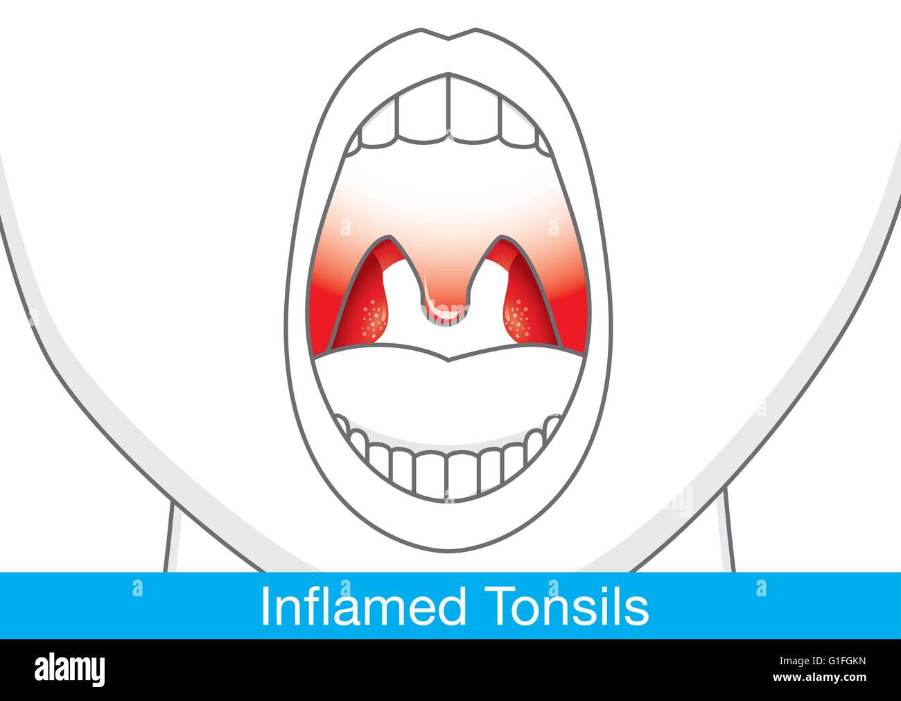 Tonsille gonfie immagini e fotografie stock ad alta risoluzione - Alamy
