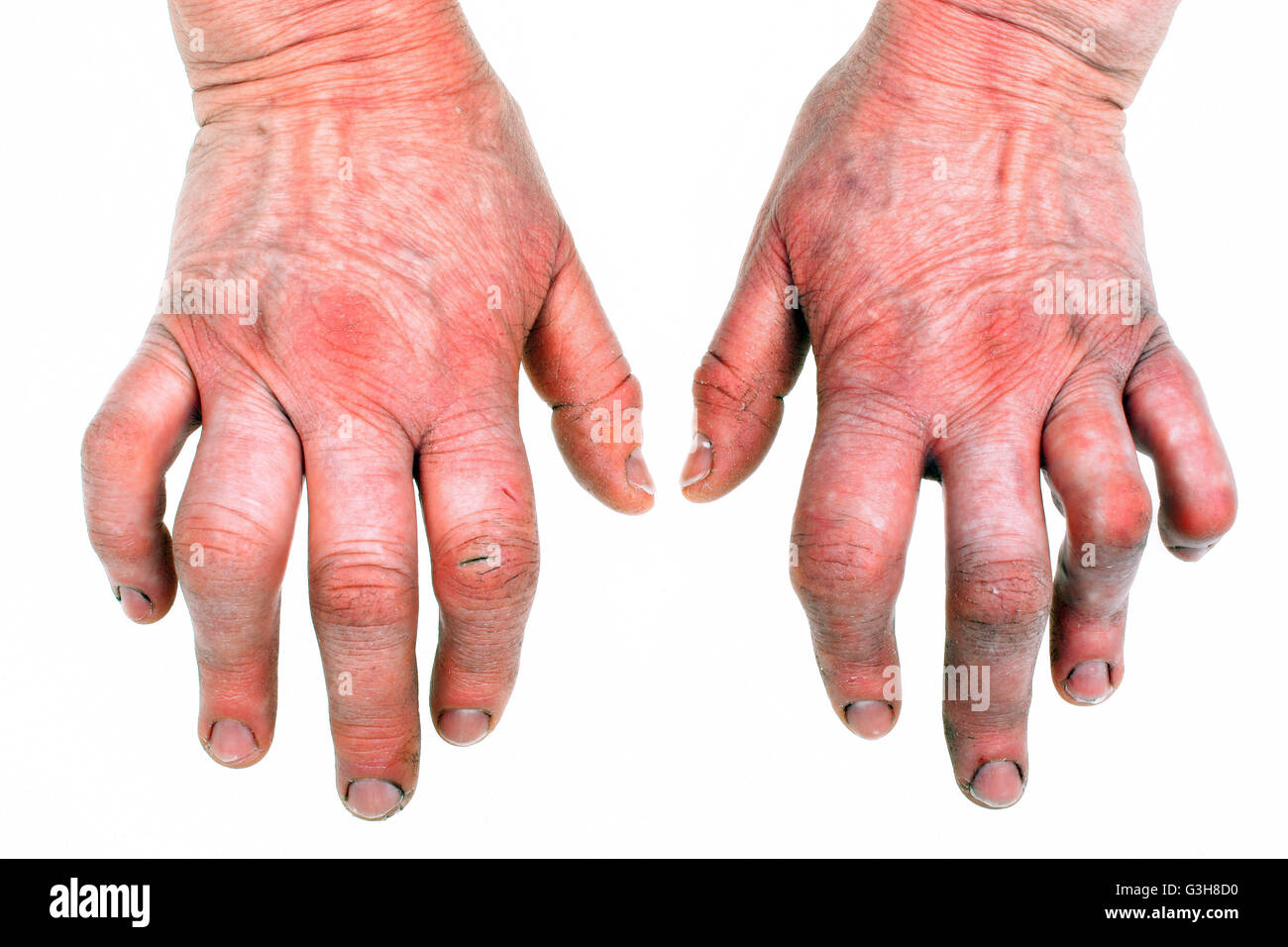 Mani deformate immagini e fotografie stock ad alta risoluzione - Alamy
