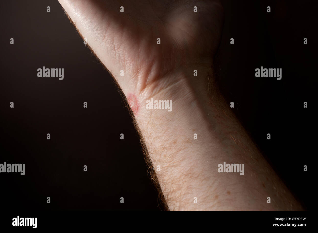 Fungo della pelle immagini e fotografie stock ad alta risoluzione - Alamy