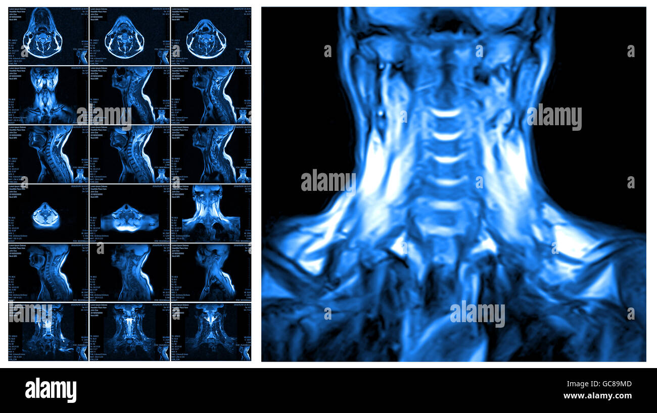 Cervicale Della Colonna Vertebrale Mri Immagini e Fotos Stock - Alamy