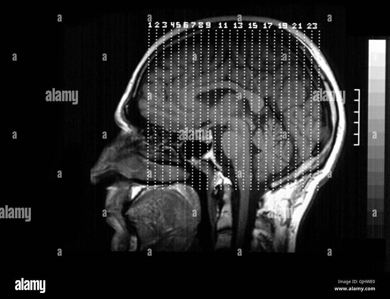 Anatomia tc encefalo Foto e Immagini Stock in Bianco e Nero - Alamy