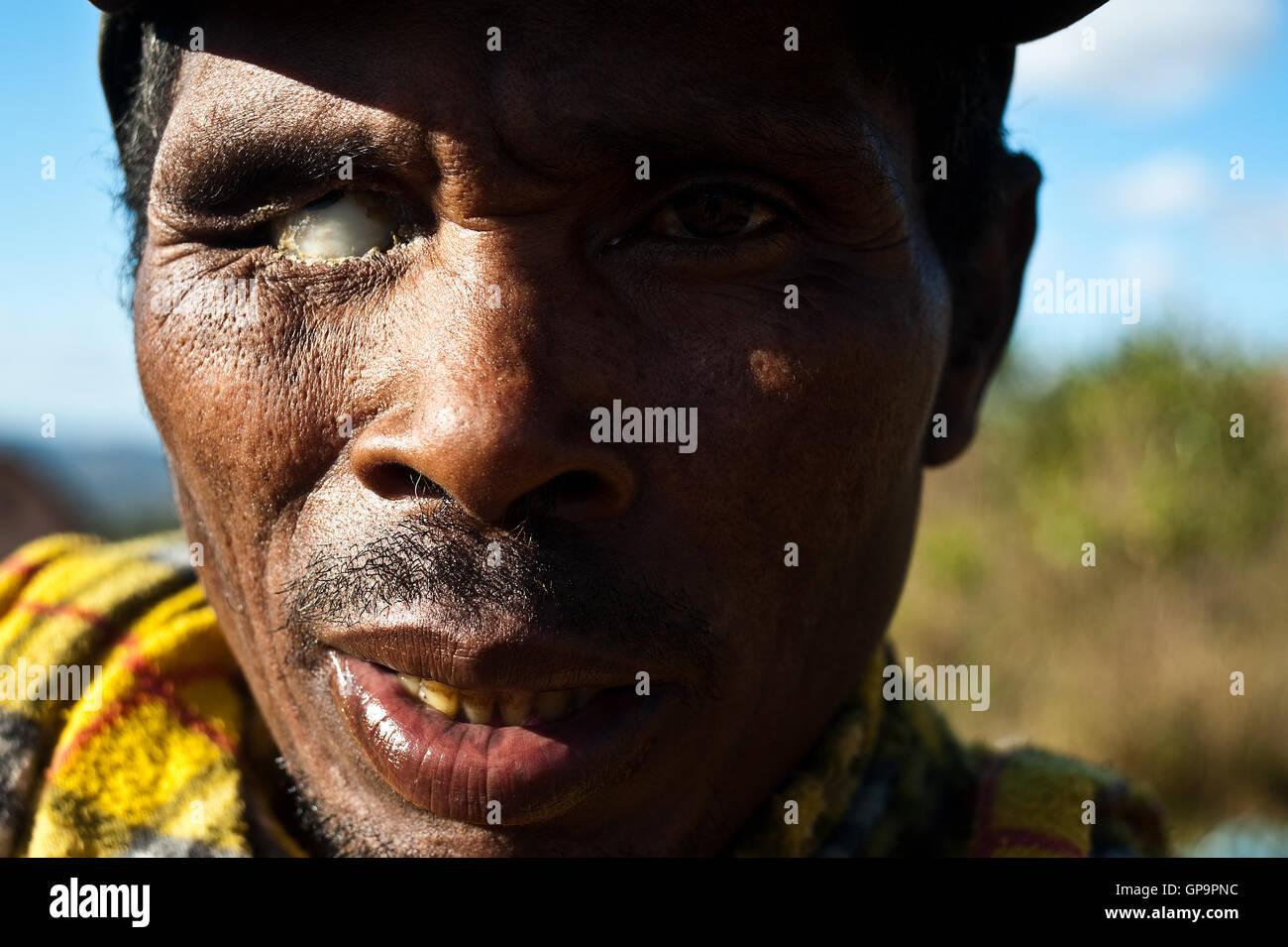 Disabilità visiva immagini e fotografie stock ad alta risoluzione - Alamy
