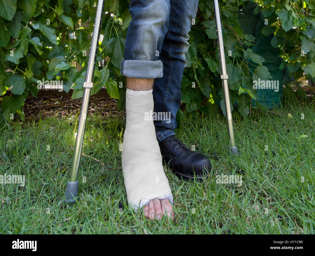 Giovane con una caviglia rotta e una fibra di vetro bianco e il calco ...