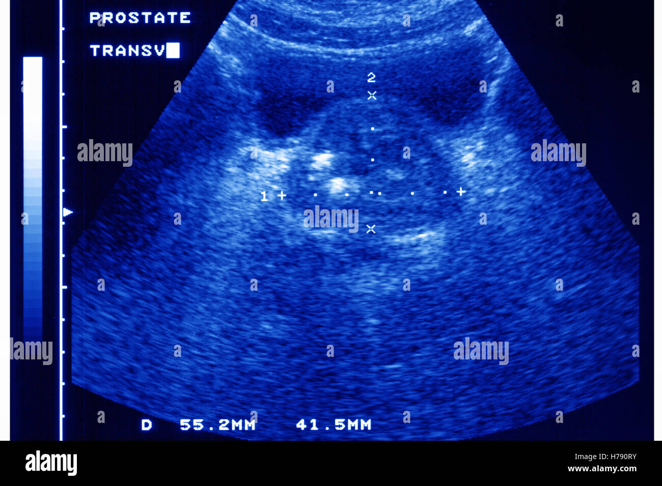 Il carcinoma della prostata, ecografia Foto stock - Alamy