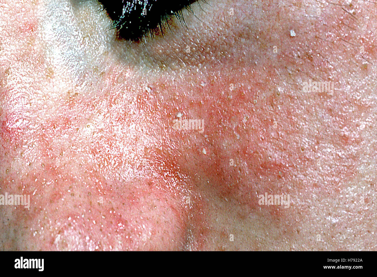 Dermatite a immagini e fotografie stock ad alta risoluzione - Alamy