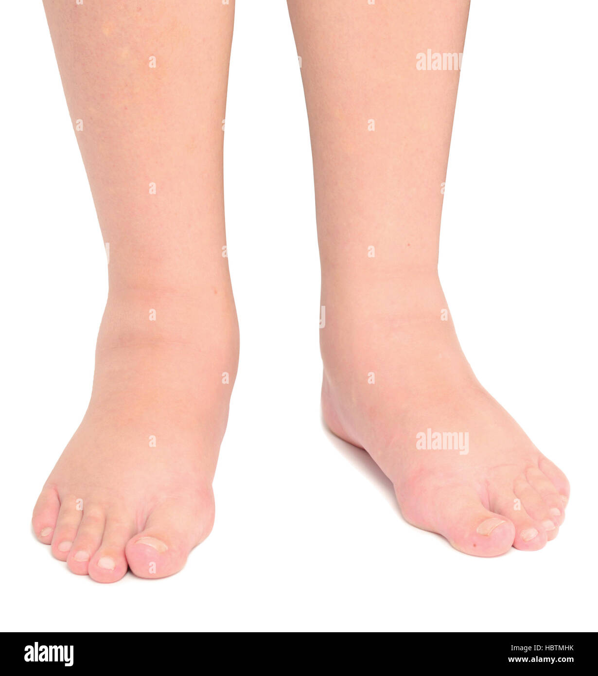 Edema alle gambe immagini e fotografie stock ad alta risoluzione - Alamy