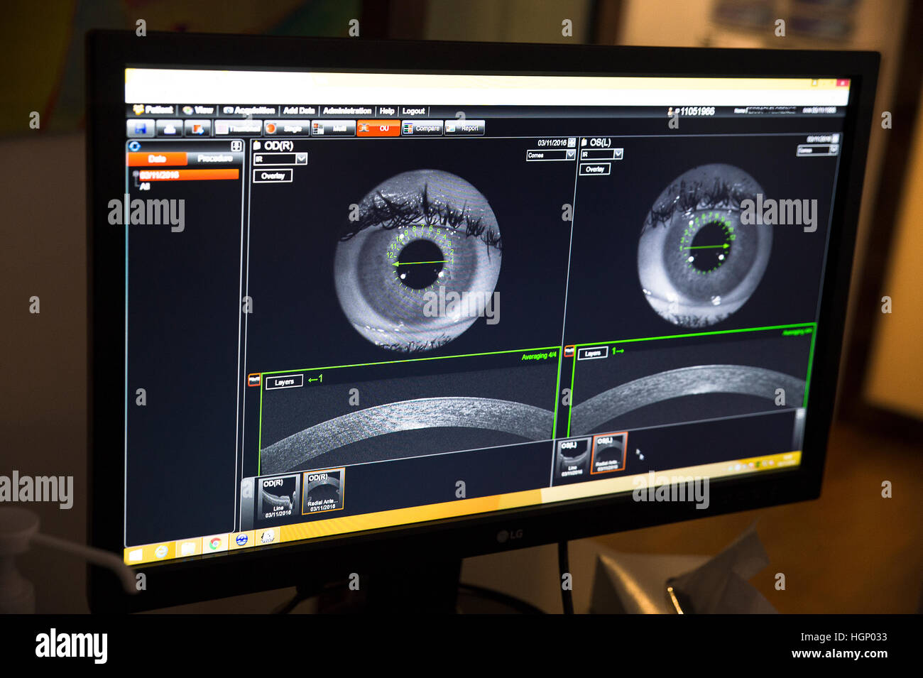 Tomografia a coerenza ottica ott immagini e fotografie stock ad alta risoluzione - Alamy
