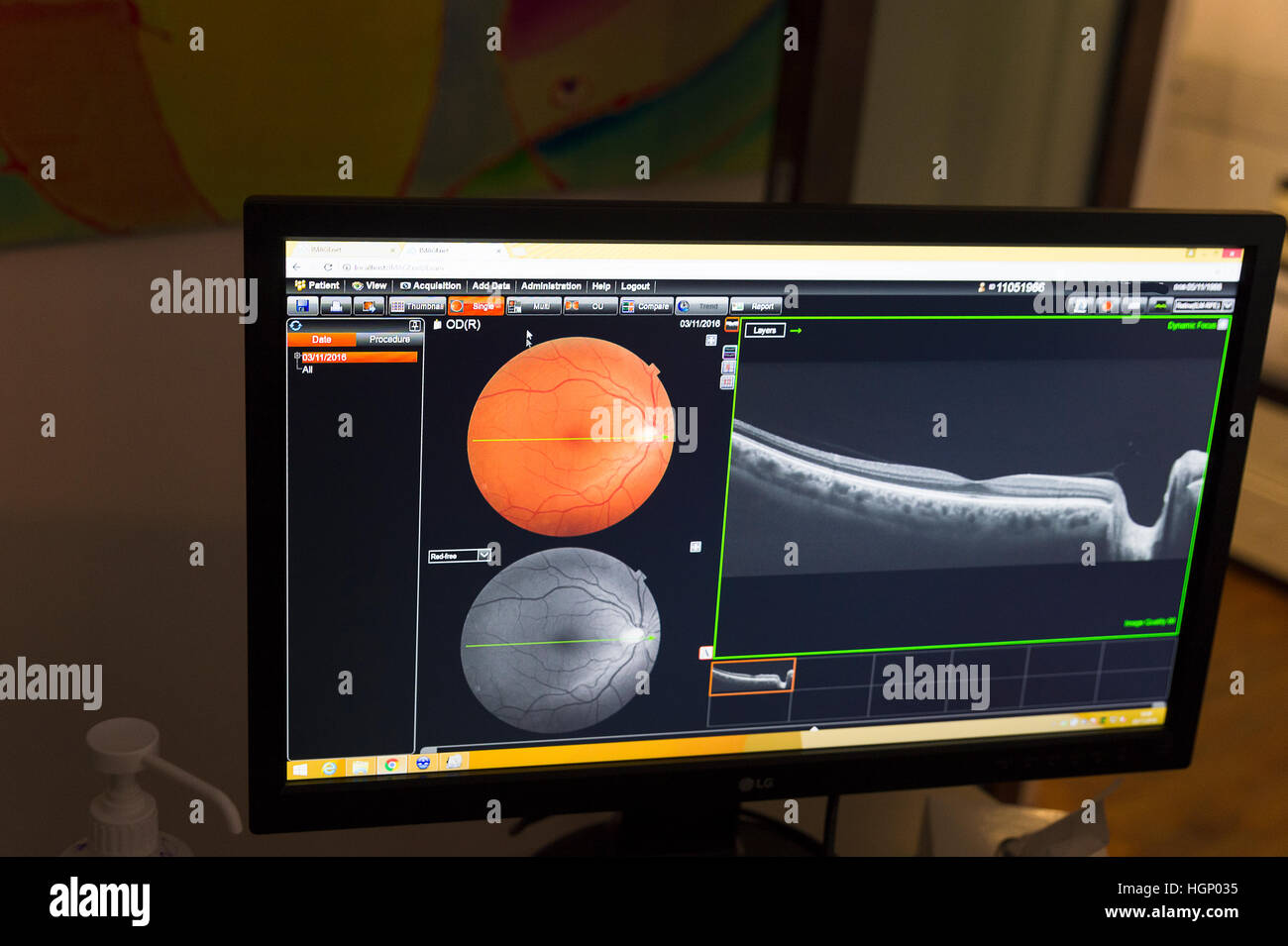 Tomografia a coerenza ottica ott immagini e fotografie stock ad alta risoluzione - Alamy