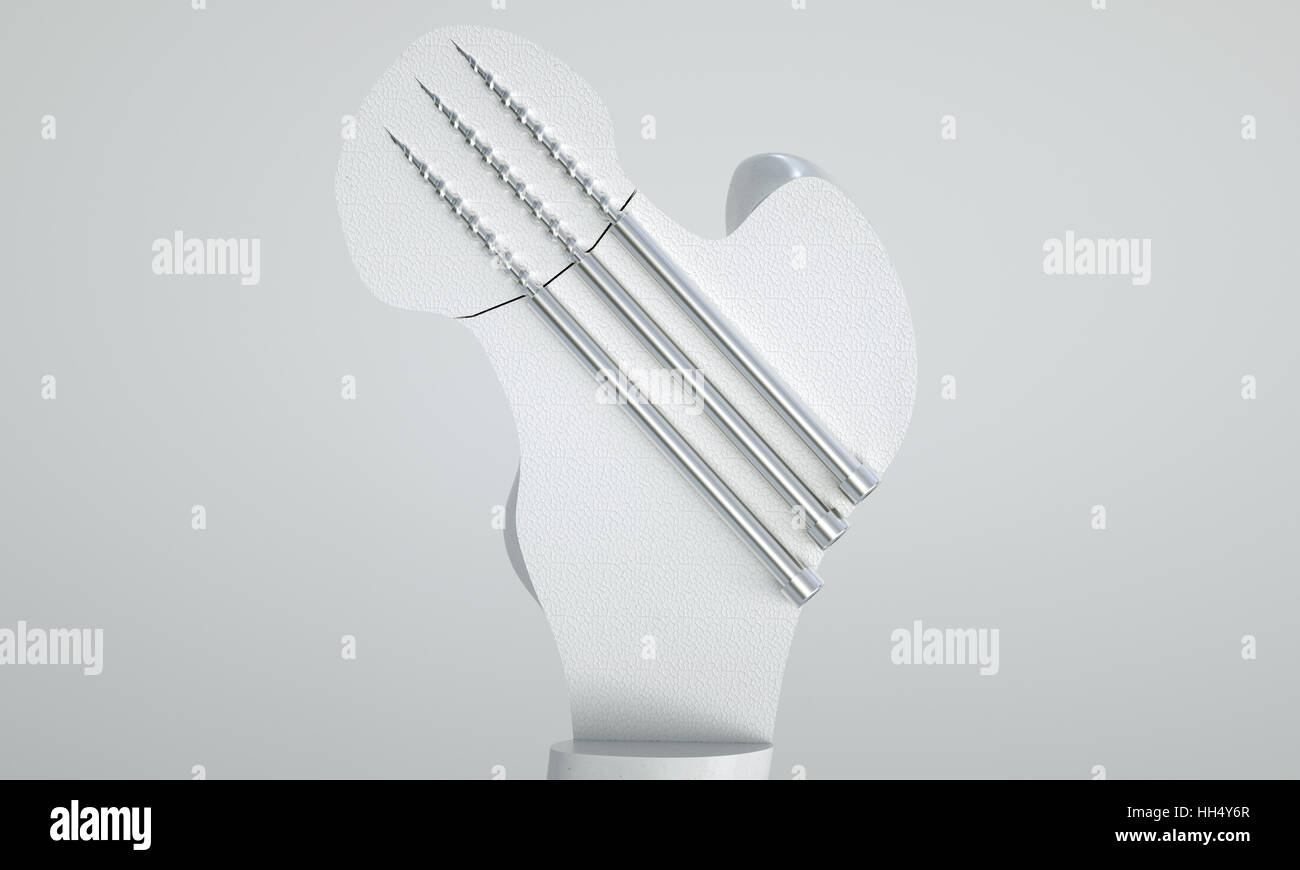 Trattamento della frattura del femore femorale immagini e fotografie ...