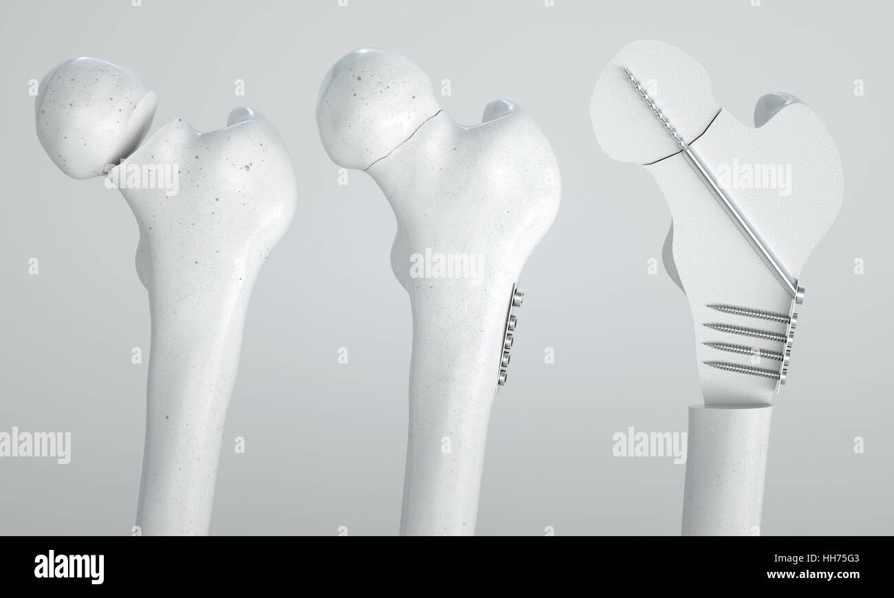 Trattamento della frattura del femore femorale immagini e fotografie ...