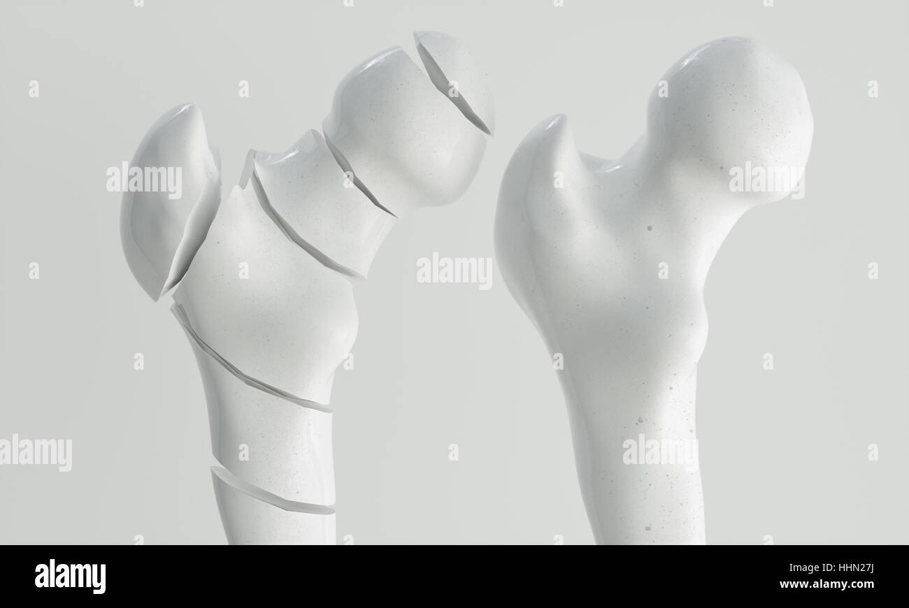 Frattura del femore immagini e fotografie stock ad alta risoluzione - Alamy