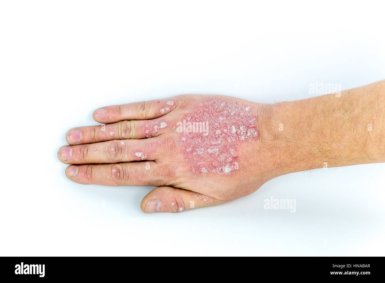 Psoriasis hand immagini e fotografie stock ad alta risoluzione - Alamy