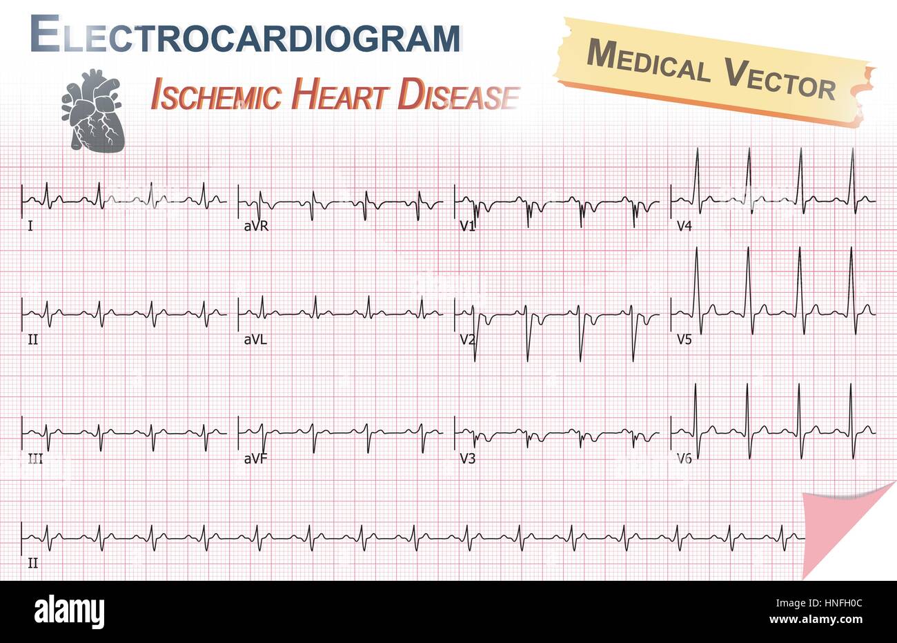Elettrocardiogramma ( ECG , EKG ) di malattie ischemiche del cuore ...