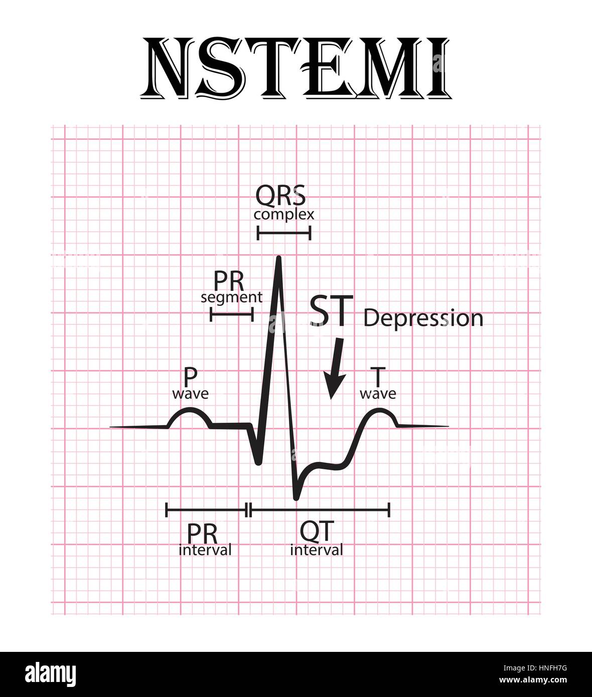 ECG non di sopraslivellamento ST infarto del miocardio (NSTEMI) e ...