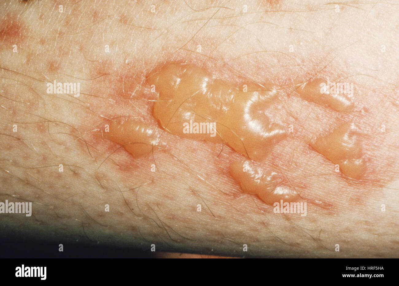 Punture di insetti immagini e fotografie stock ad alta risoluzione - Alamy