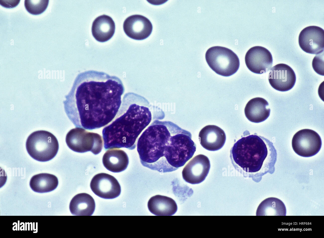 Leucemia linfocitica acuta immagini e fotografie stock ad alta ...
