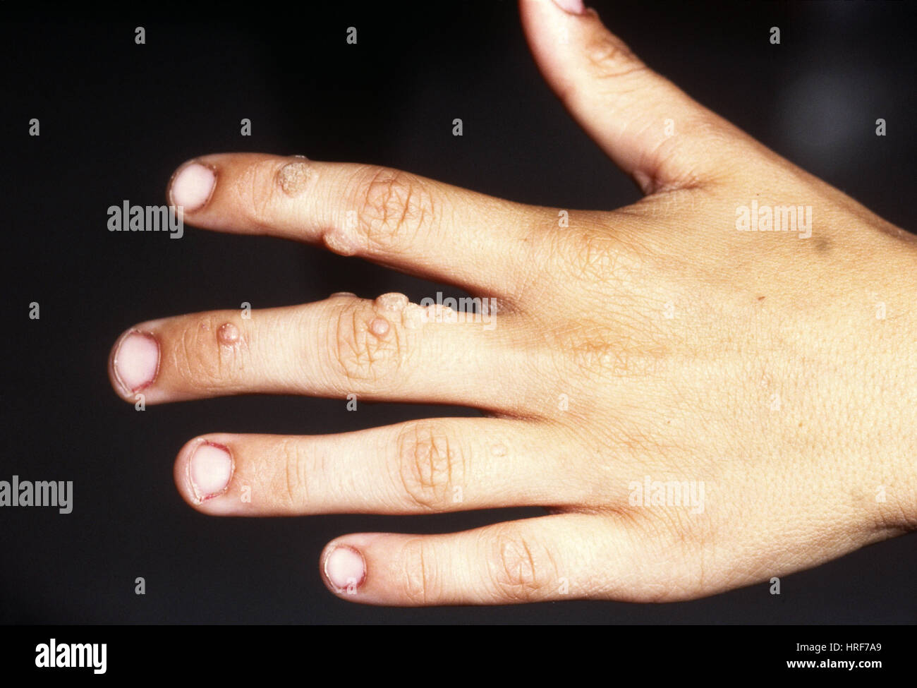 Verruche virali immagini e fotografie stock ad alta risoluzione - Alamy