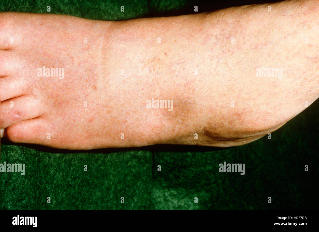 Edema pitting immagini e fotografie stock ad alta risoluzione - Alamy