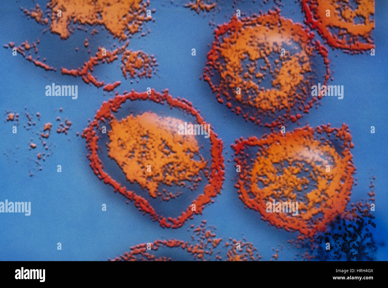 Sindrome da immuno deficienza acquisita immagini e fotografie stock ad alta risoluzione - Alamy