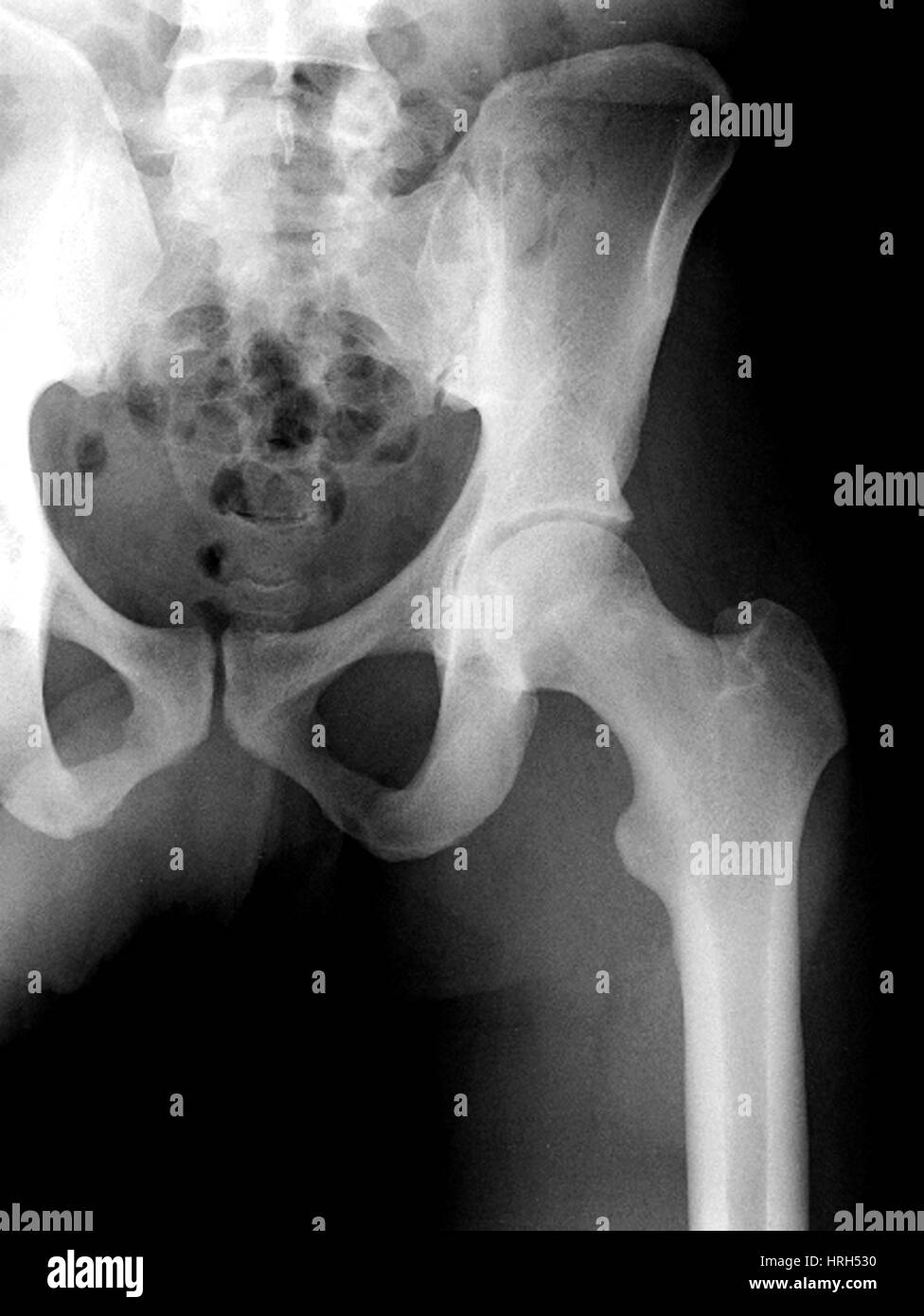 Osso femorale Foto e Immagini Stock in Bianco e Nero - Alamy