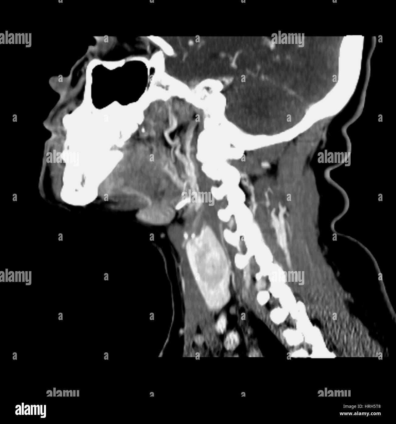 Nodulo tiroideo immagini e fotografie stock ad alta risoluzione - Alamy