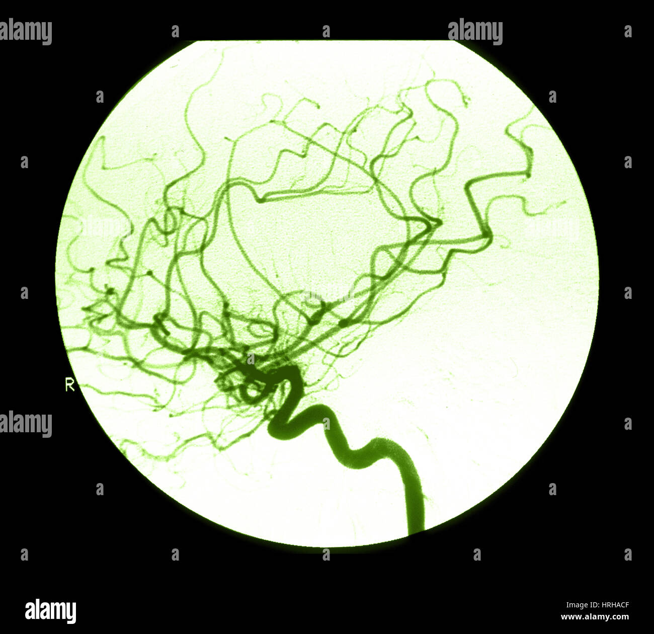Carotid angiography immagini e fotografie stock ad alta risoluzione - Alamy