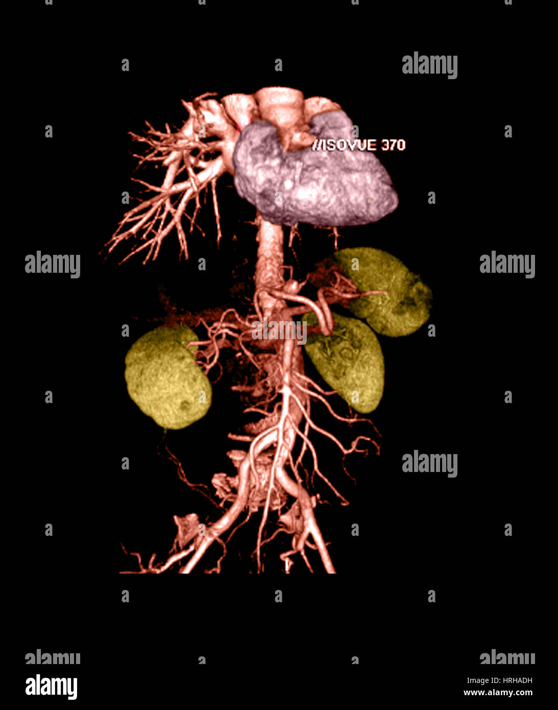 Cta dell'aorta addominale immagini e fotografie stock ad alta risoluzione - Alamy