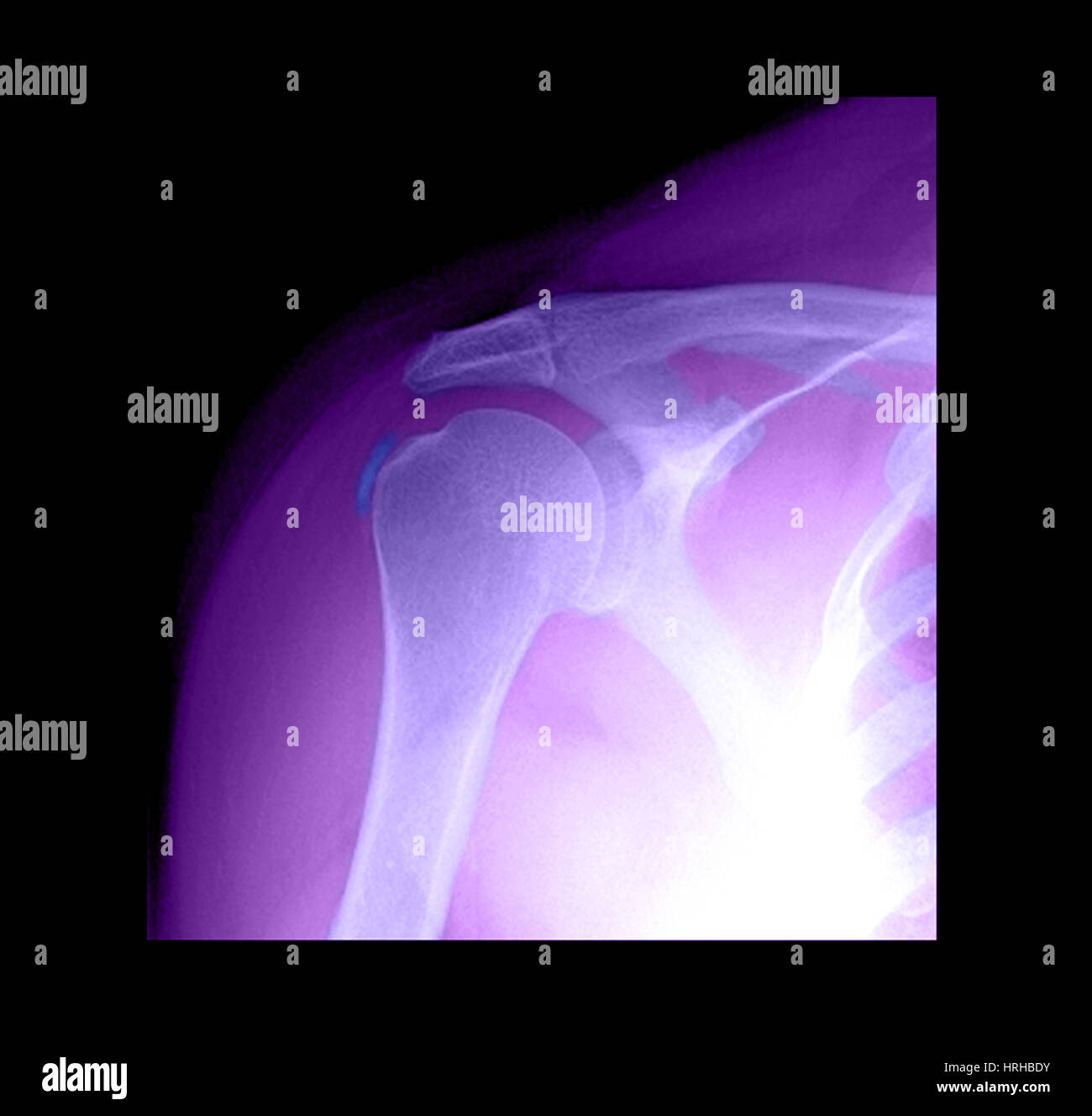 Tendini rotatori spalla immagini e fotografie stock ad alta risoluzione ...