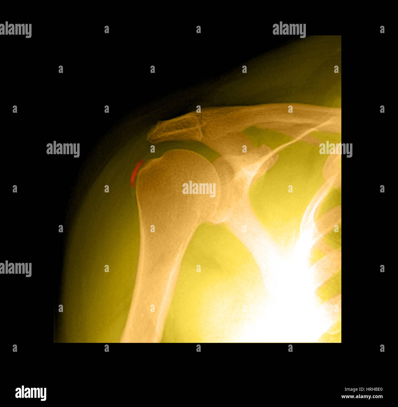 Tendini rotatori spalla immagini e fotografie stock ad alta risoluzione ...