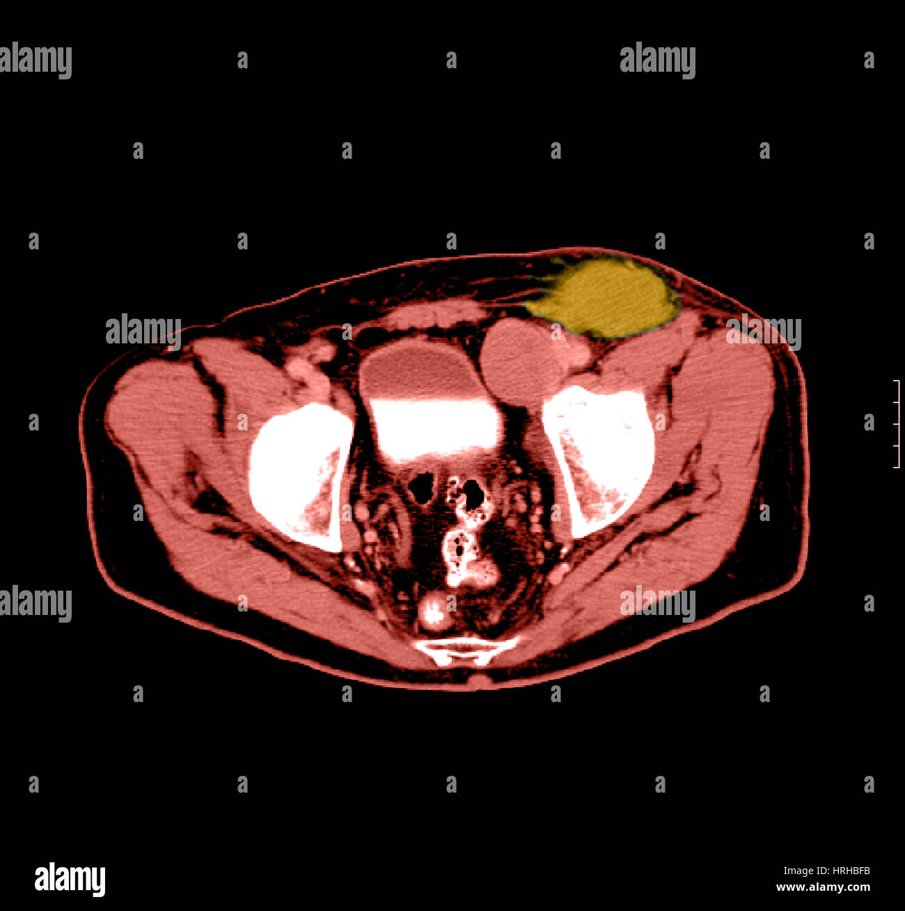 Anatomia inguinale immagini e fotografie stock ad alta risoluzione - Alamy