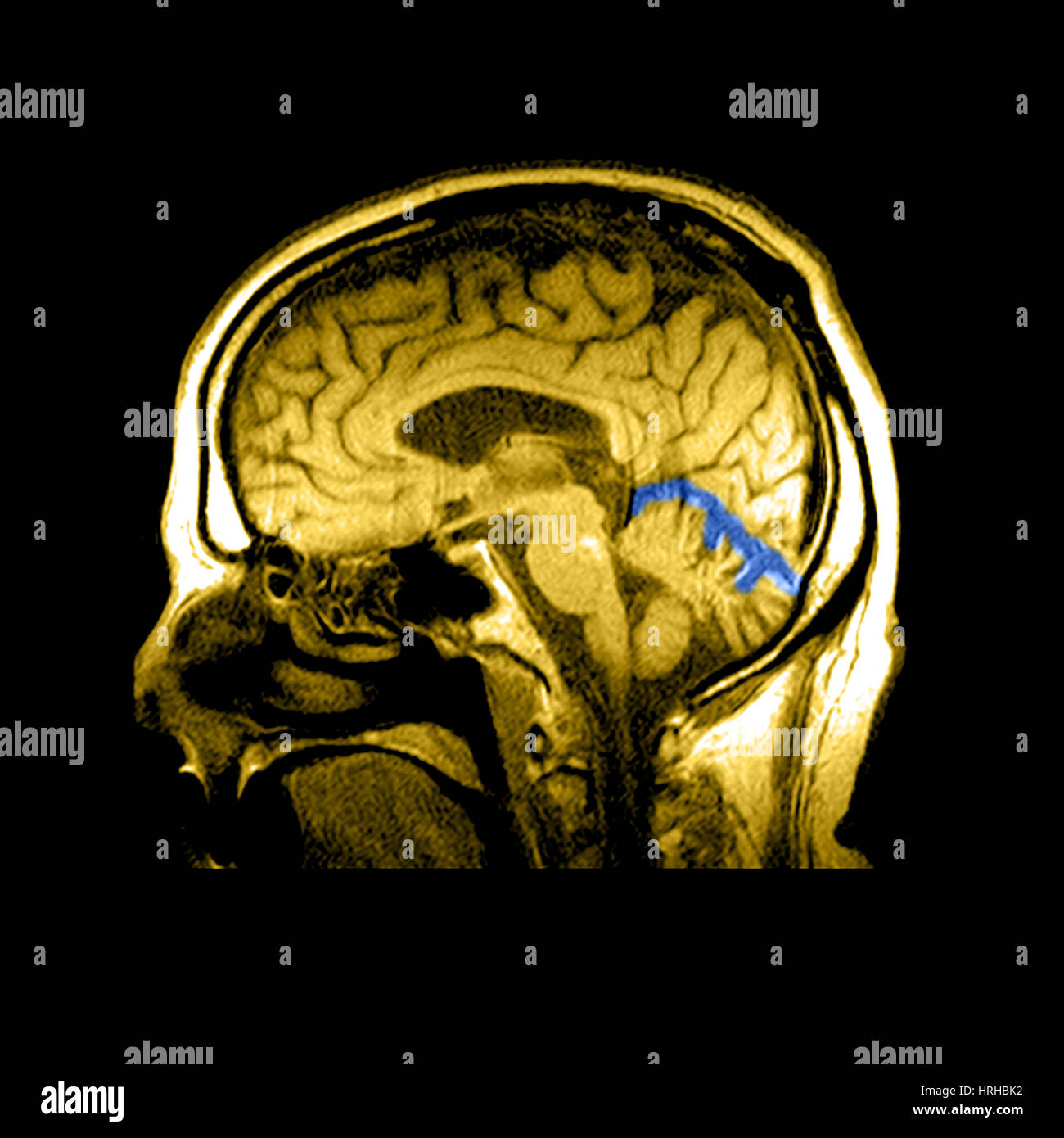 Superior vermis of the cerebellum immagini e fotografie stock ad alta ...
