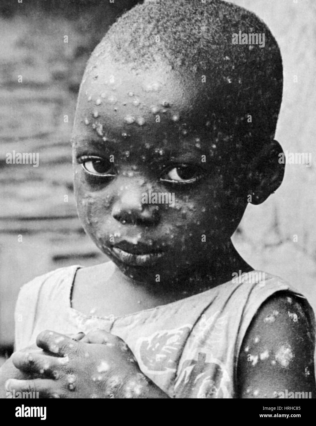 Variola vera immagini e fotografie stock ad alta risoluzione - Alamy