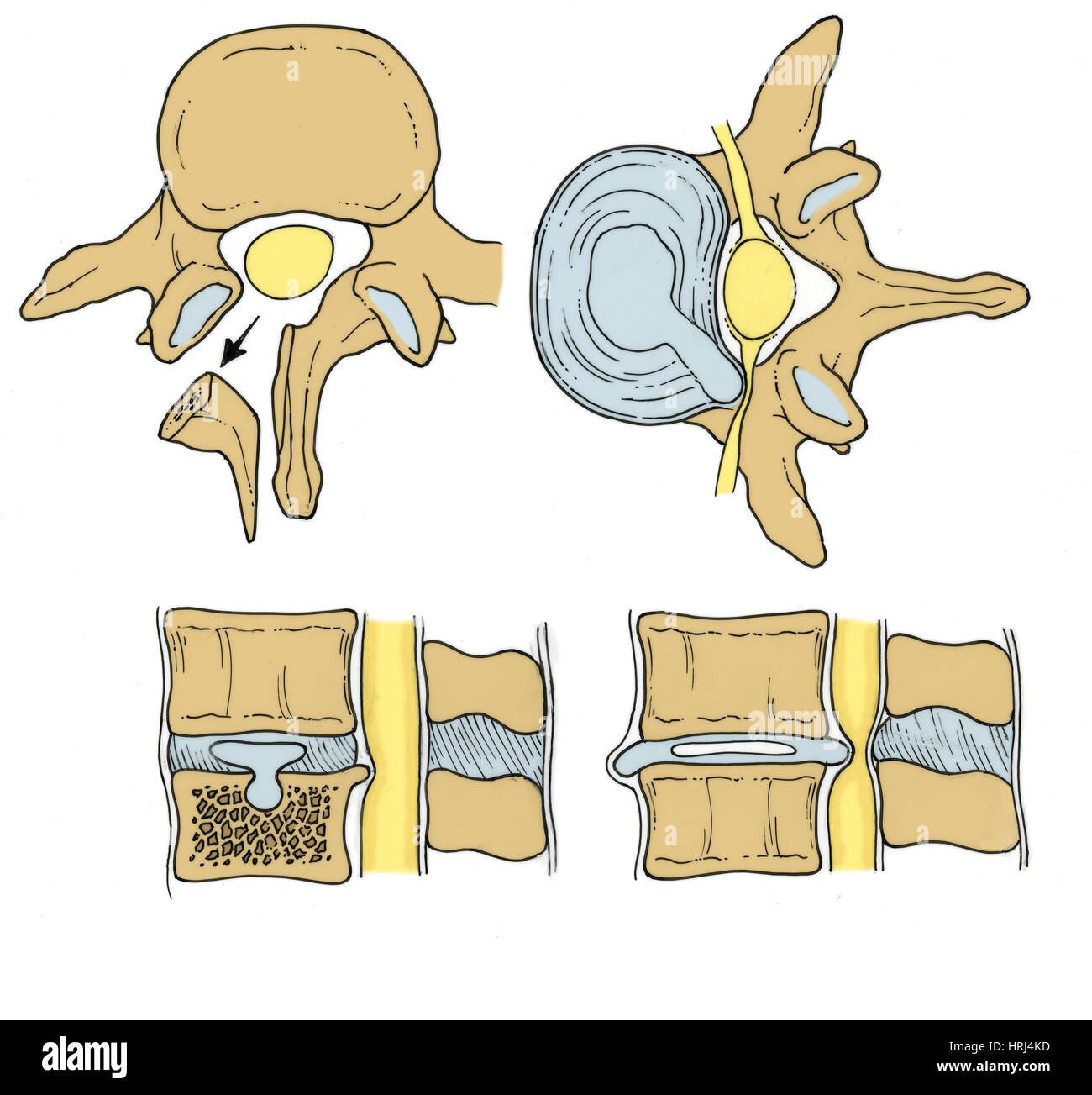 Ligamentum flavum immagini e fotografie stock ad alta risoluzione - Alamy