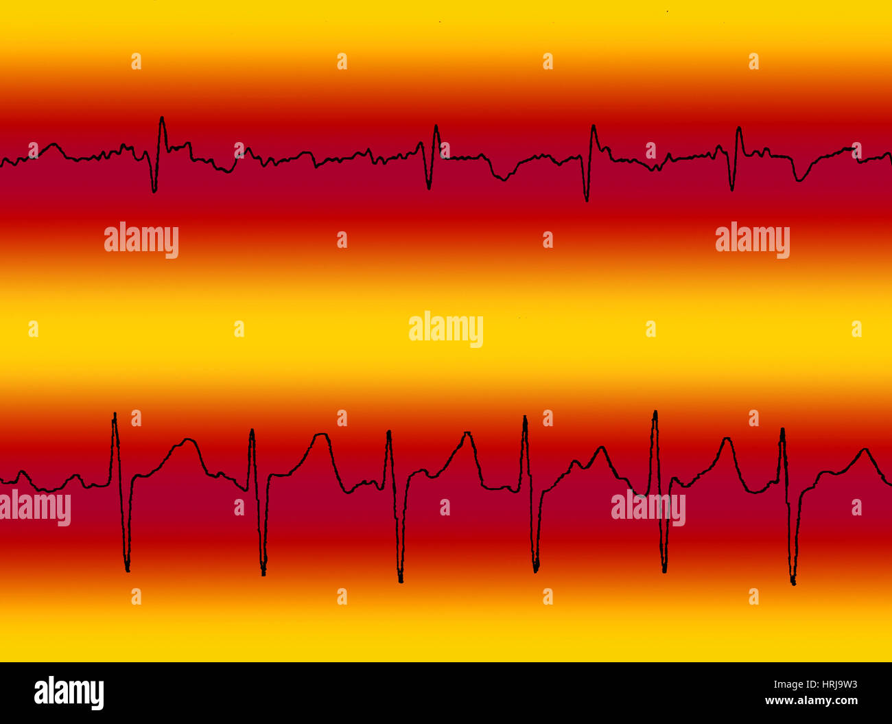 Flutter atriale ekg immagini e fotografie stock ad alta risoluzione - Alamy