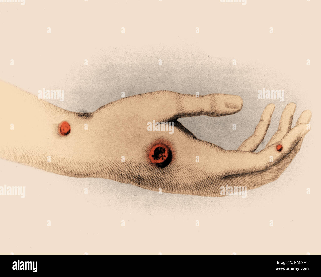 Vittima del vaiolo immagini e fotografie stock ad alta risoluzione - Alamy