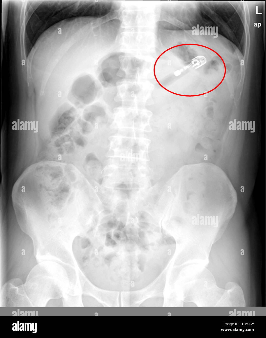 Vetrino di esofago immagini e fotografie stock ad alta risoluzione - Alamy