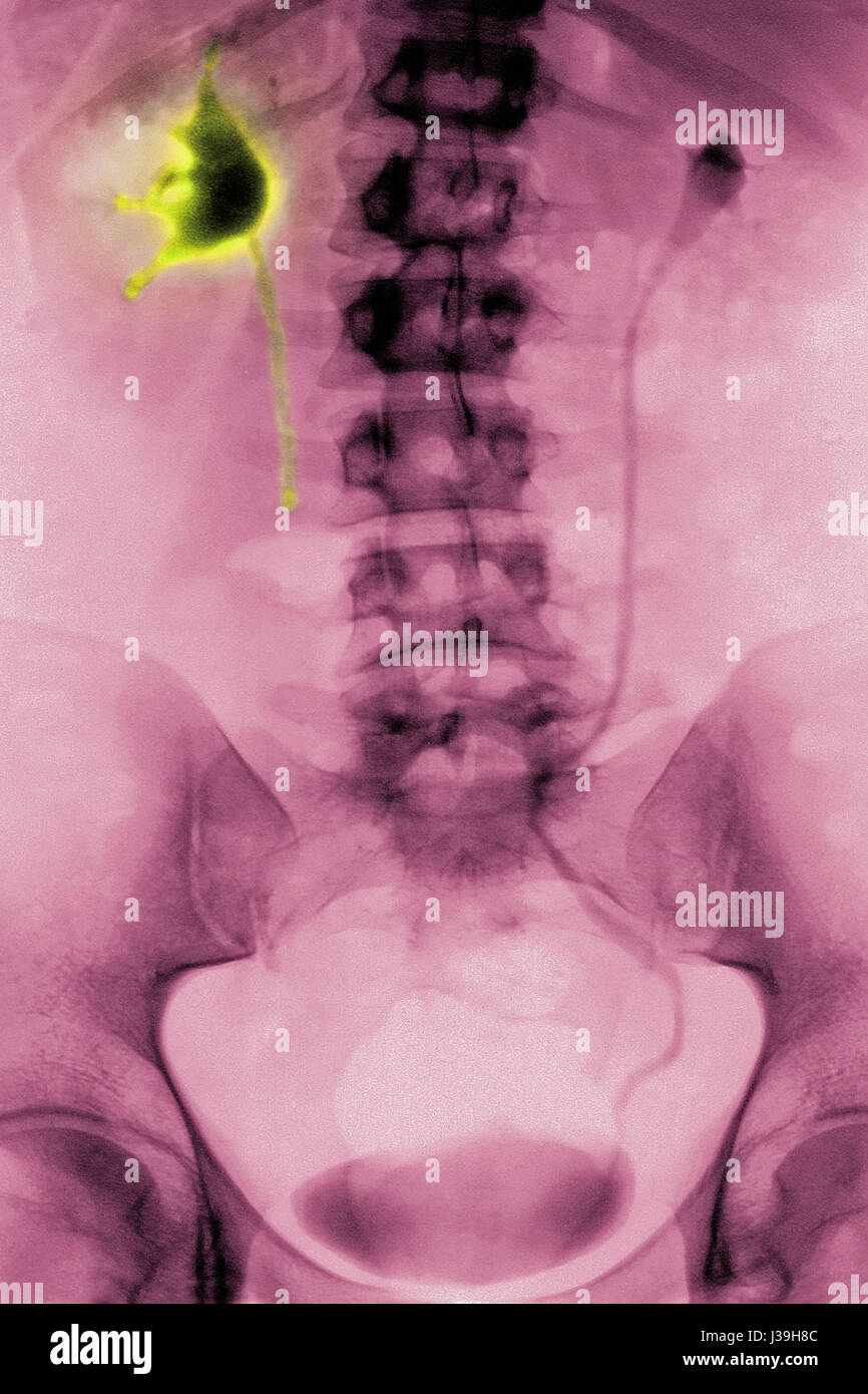 Colica nefritica immagini e fotografie stock ad alta risoluzione - Alamy
