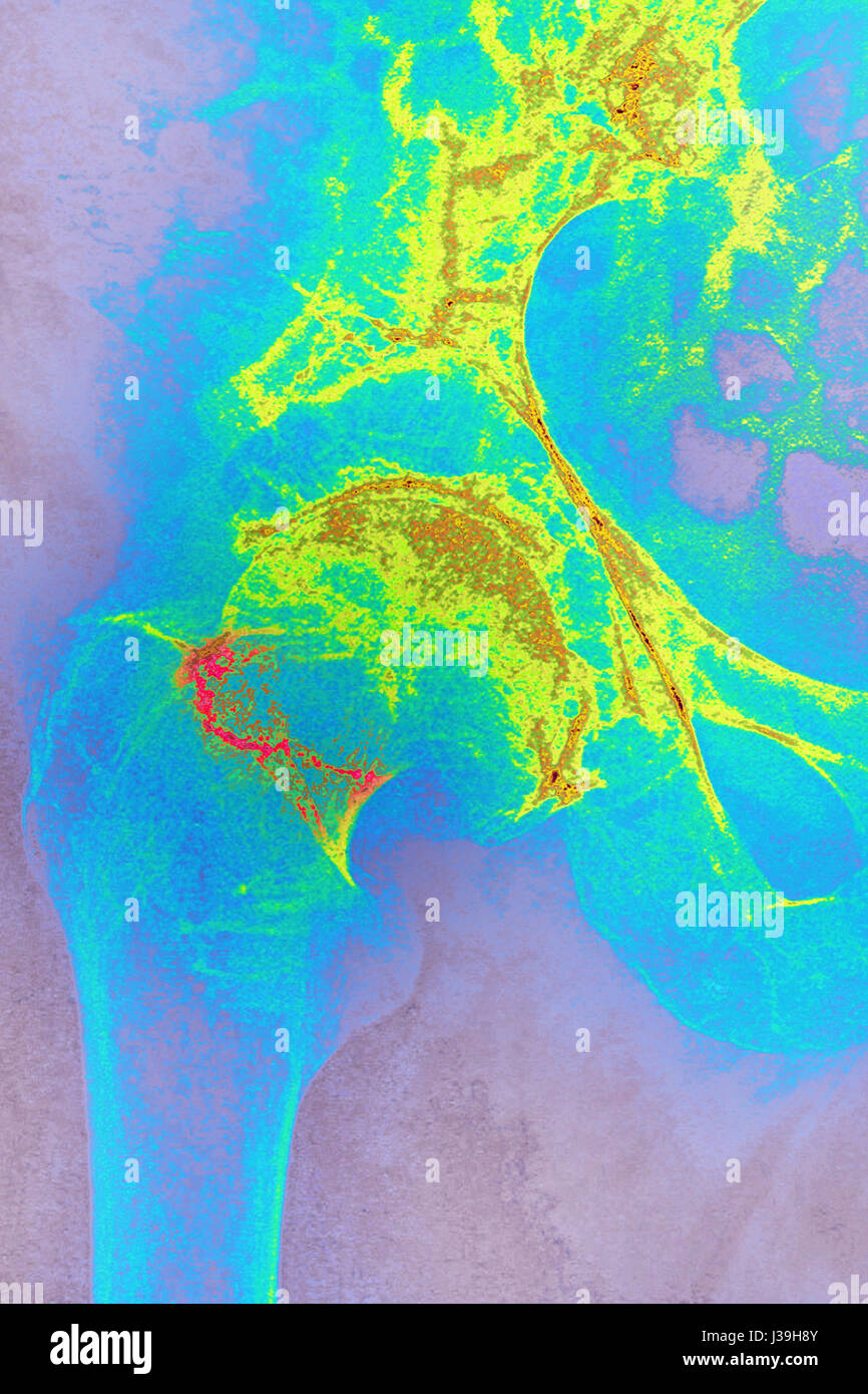 Anca fratturata immagini e fotografie stock ad alta risoluzione - Alamy