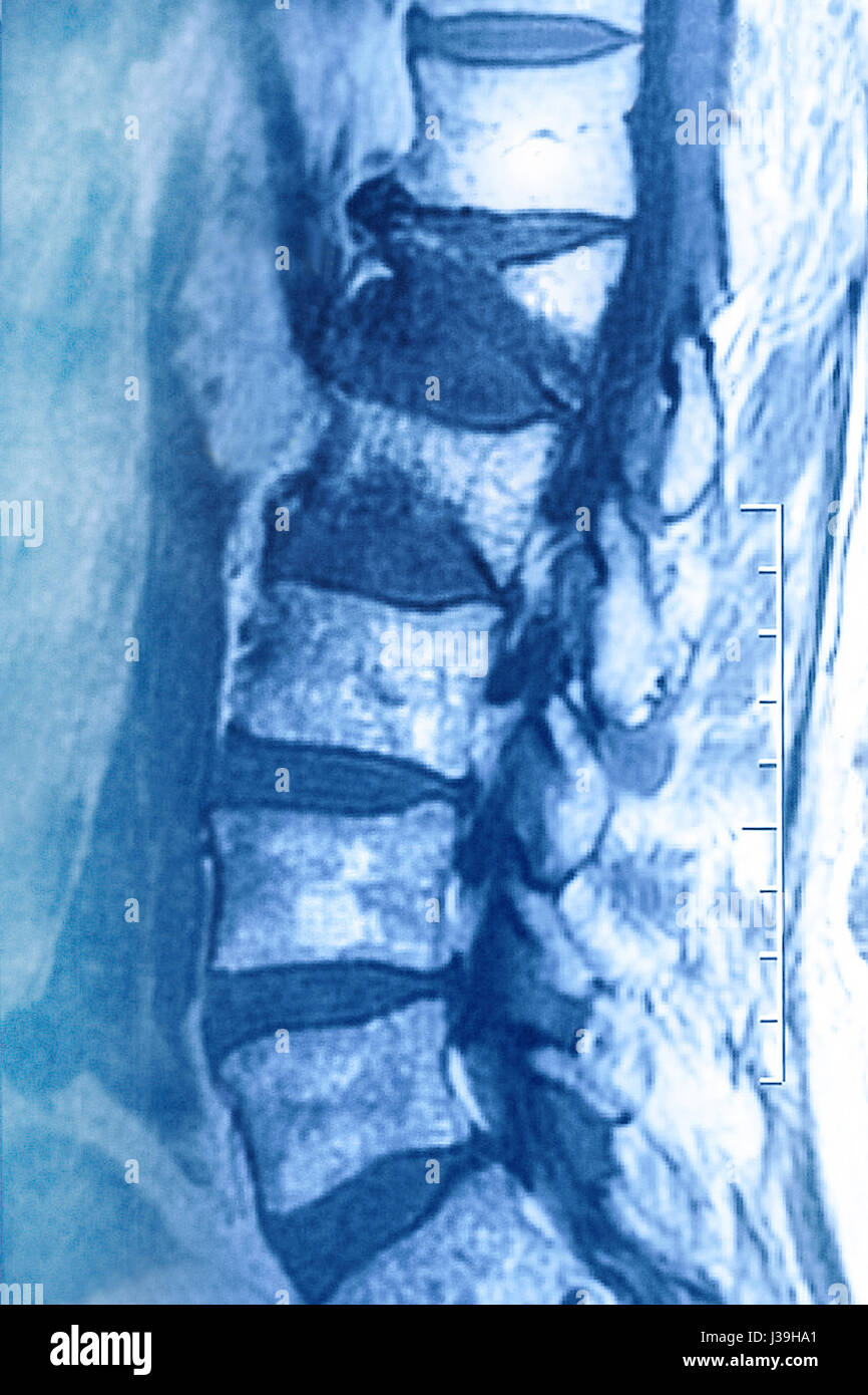 Mri di frattura da compressione lombare immagini e fotografie stock ad ...
