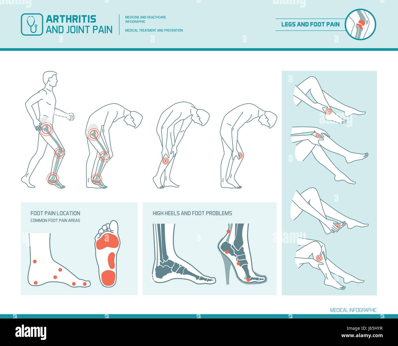 Piede dolore, dolore alle gambe e artrite ed infografico: infiammazione ...