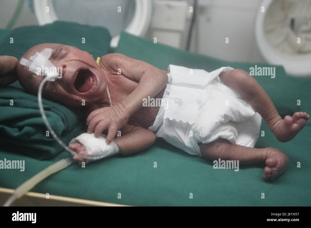 Hutchinson gilford progeria syndrome immagini e fotografie stock ad ...